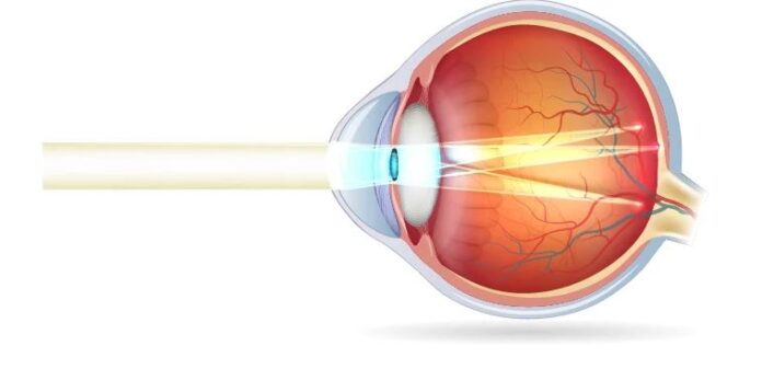 Detailed Information on Astigmatism & Its 5 Proven Treatments